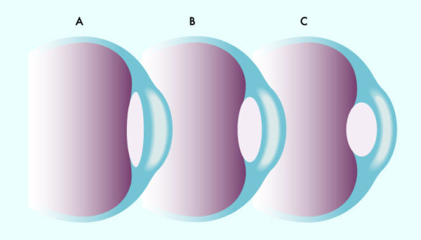 Schematische-Darstellung-der-Akkommodation